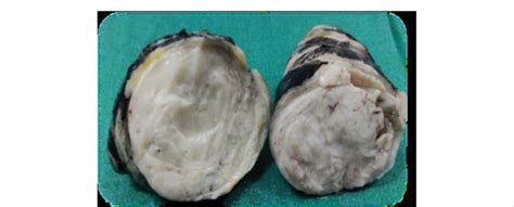 Smooth Lobulated Mass Measuring 11 × 65 × 35 Cm Cs Circumscribed