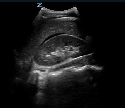 Fast Sonoguide
