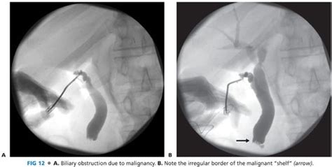 Intraoperative Cholangiogram Basicmedical Key