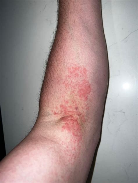 One Week Post Surgery Rash On My Iv Site Rmedical