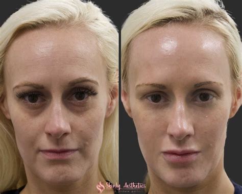 eyes dark circles before after