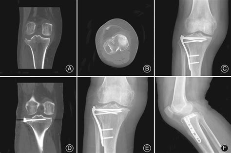 Tibial Plateau Fracture Repair