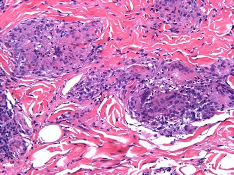 Dysesthesia Sarcoidosis At Jenenge Blog