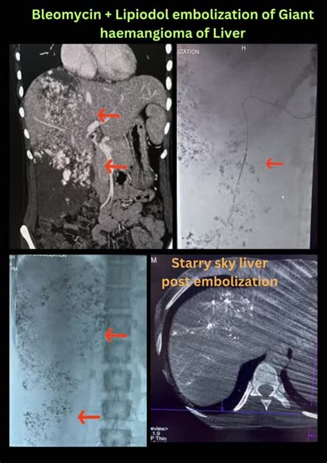 Dr Amrin Ir On Linkedin Starryliver Minimalinvasivesurgery Embolization Intervention