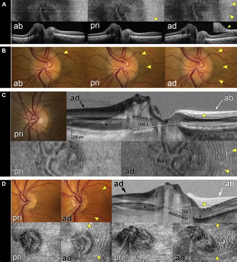 Papilledema Grading