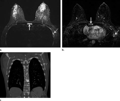 Osseous Metastases In A 40 Year Old Woman With Newly Diagnosed Cancer Download Scientific