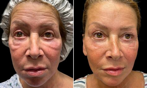 Lee Canthoplasty