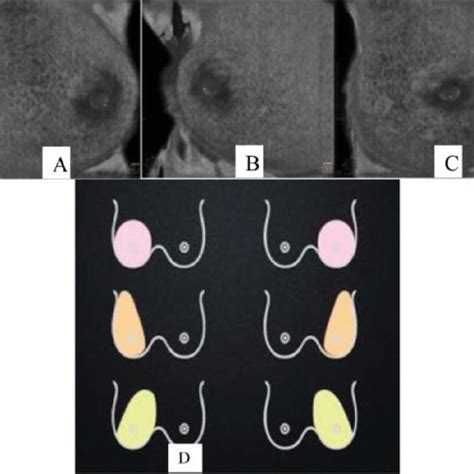 Automated Breast Ultrasound Acquires Images A Lateral View B Medial