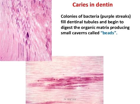 Histopathology Of Dental Caries Dr Maji Jose Smooth