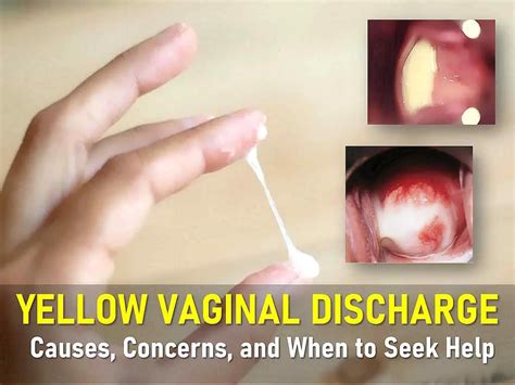 Light Yellow Discharge Yeast Infection Types Of Vaginal Discharge