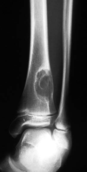 Non Ossifying Fibroma Pathology Orthobullets