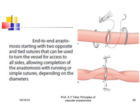 Principles Of Vascular Anastomosis Ppt First Aid Injuries
