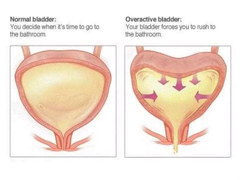 Monitoring Of Intake And Output Pptx