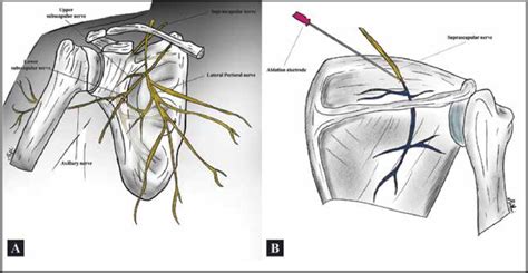 Rfa Of The Ssc Nerve At The Shoulder Download Scientific Diagram
