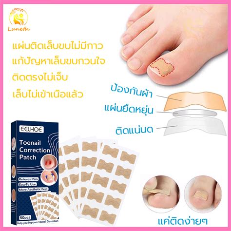 Eelhoe แผ่นแปะเล็บขบ น้ำยารักษาเล็บรักษาเล็บขบ เล็บเปราะ เล็บไม่เรียบ ซ่อมเล็บที่ชำรุด การแก้ไข