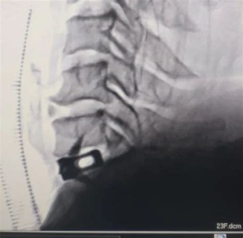 Titanium Anterior Cervical Discectomy And Fusion Acdf At ₹ 3500 Piece In Vadodara