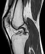 Magnetic Resonance Imaging Of Anterior Cruciate Ligament Injury Orr