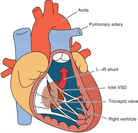 Membranous Vsd In Babies