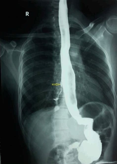 Tracheoesophageal Fistula Barium Swallow