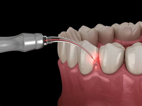 Gum Surgery In Brampton On Gum Surgery Near Me