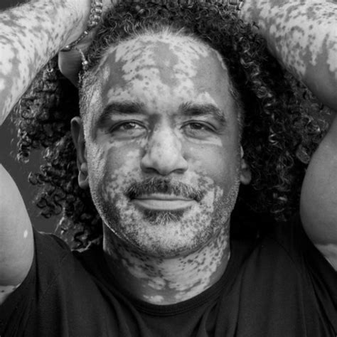 World Vitiligo Day 2023 Celebration Roundup The Vitiligo Society