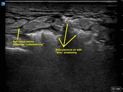 Necrotizing Fasciitis Archives Pocus Journal