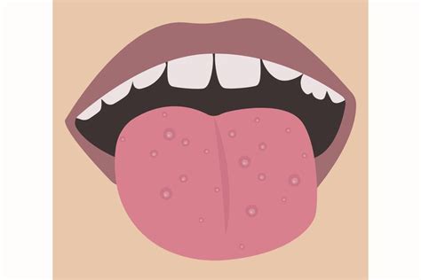 Kenapa Ada Biji Merah Di Lidah KadencetaroRivas