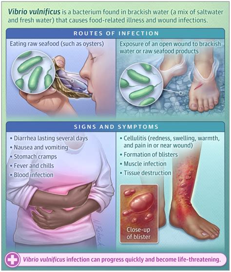 Patient Information Vibrio Vulnificus Jama