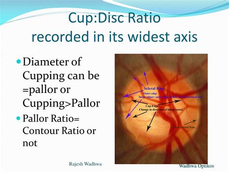 Ppt An Example Of Glaucoma Detection In Indian Optometry Clinic Powerpoint Presentation Id
