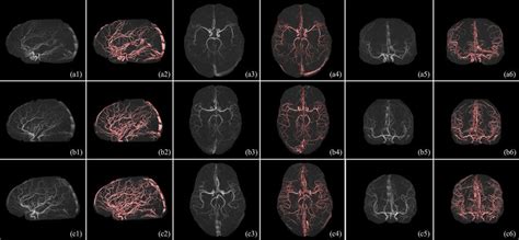 Dd Cnn Segmentation Results From Three Tof Mra Samples Columns