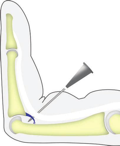 29 PIP Anesthetic Injection Pain May Limit PIP Extension Before The Download Scientific