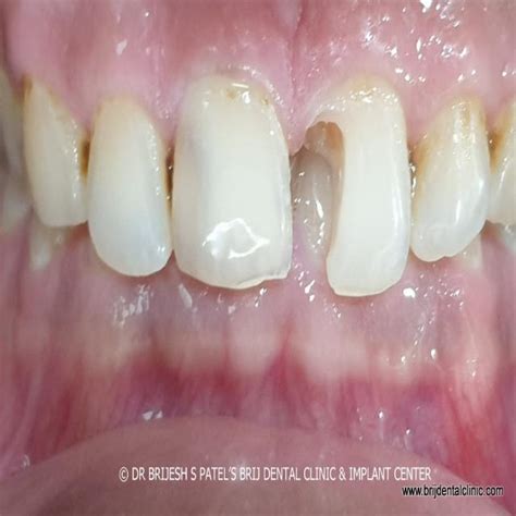 Big Cavity Object Detection Dataset V1 2024 02 13 9 02pm By Mahos