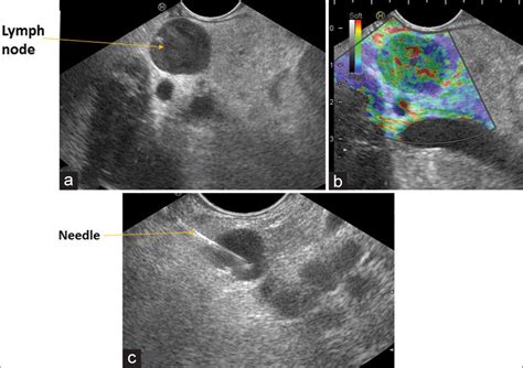 Endoscopic Ultrasound Guided Fine Needle Aspiration Cytology In