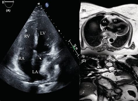 A Transthoracic Echocardiogram Showing An Echogenic Mass Arrow In Download Scientific