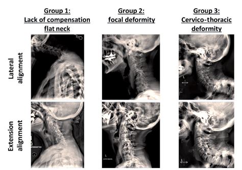 Figure 3 From Planning Cervical Deformity Surgery Including Djk
