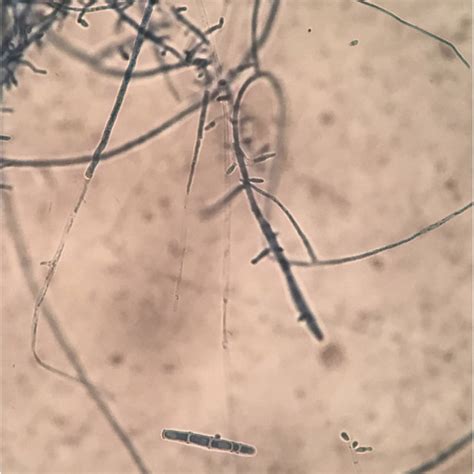 Microscopic Examination Showed Clublike Macroconidia And Microconidia Microscopic Examination Showed Clublike Macroconidia And Microconidia