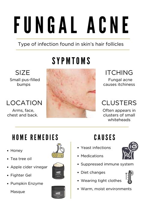 Discover 28 Acnehyperpigmentation And Acne Ideas Hyperpigmentation Acne Hyperpigmentation
