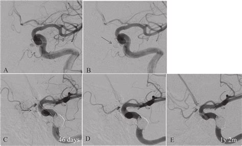 Coil Embolization Towards The Ophthalmic Artery Aneurysm A B Download Scientific Diagram
