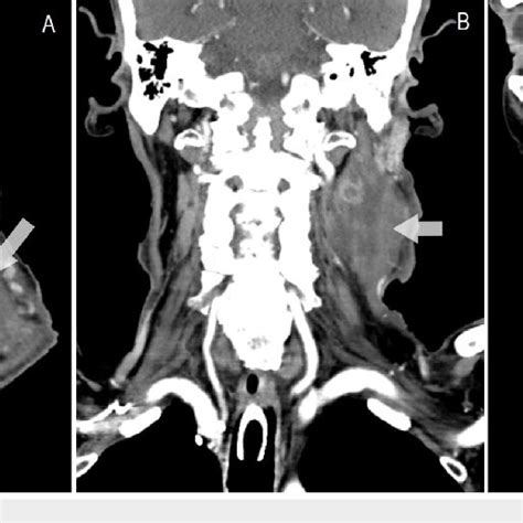 Cervical Ct Scan After Radiotherapy Showing Significant Decrease In