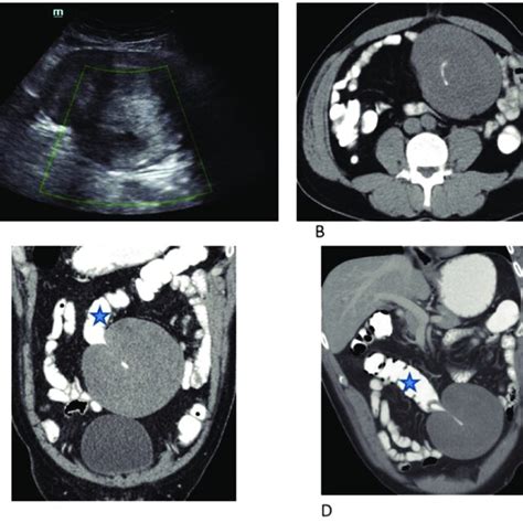 Ultrasound A Image Showing Heterogeneous Mass In The Epigastrium