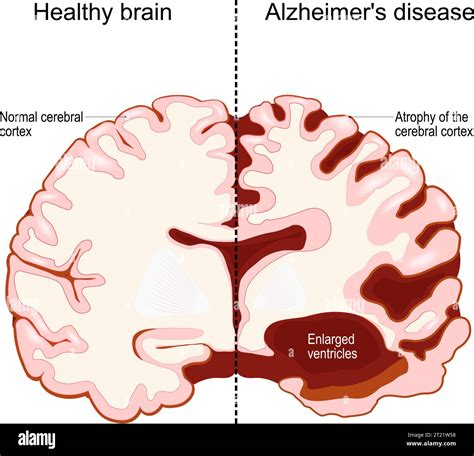 Human Brain In Two Halves Healthy And Alzheimers Disease Neurodegenerative Disorder