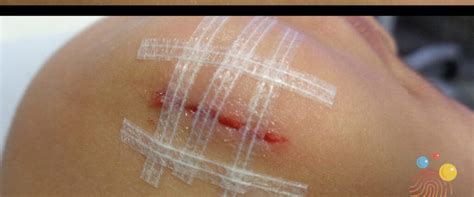 Laceration Vs Abrasion How Specialists Identify And Treat These Common