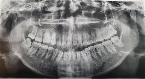 Wisdom Tooth Erupted After 1 Year Of Mewing But Its Impacted Whats