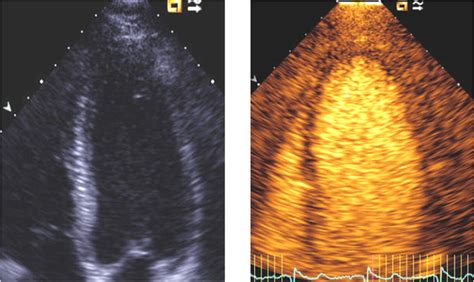Contrast Echocardiography In Coronary Artery Disease Intechopen
