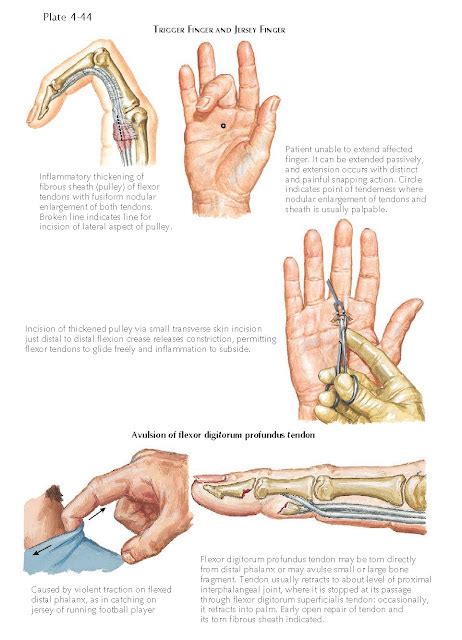 Tendon Disorders In The Hand Pediagenosis