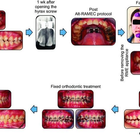 Pdf Correction Of Late Adolescent Skeletal Class Iii Using The Alt