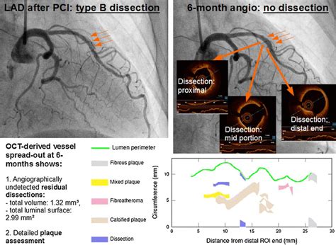 Example Of A Performed Dcb Only Pci Of The Left Anterior Descending Download Scientific Diagram