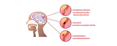 โรคหลอดเลือดสมอง Stroke หรือโรคอัมพฤกษ์ อัมพาต โรงพยาบาลสุขุมวิท