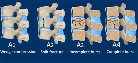 The Radiology Assistant Ao Spine Classification Of Thoracolumbar Fractures