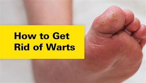 Getting Rid Of Warts Prescription Vs Over The Counter